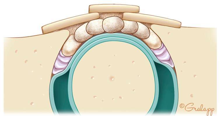 Surgery | Superior Canal Dehiscence Syndrome (SCDS)